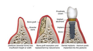 Jaw Bone Grafting Sunshine Coast | SCOFIS